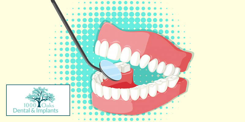 5 Ways to Stop Bleeding Gums - 1000oaks Dental & Implants: Dentists ... 5 Ways to Stop Bleeding Gums - 1000oaks Dental & Implants: Dentists ...