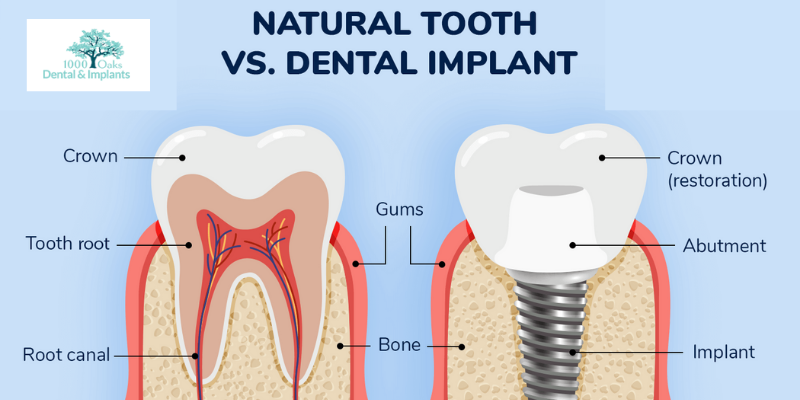Which is more Suitable, Root Canal, or Implant? - 1000oaks Dental ...